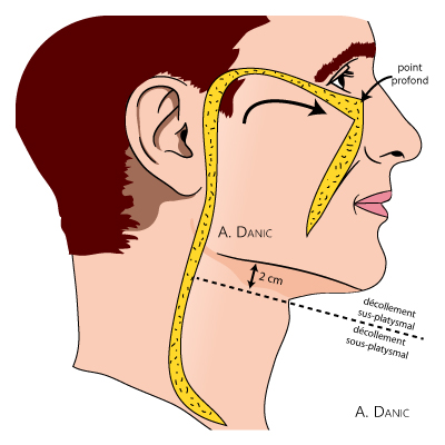 Lambeau de rotation cervico-jugal - lambeauclic