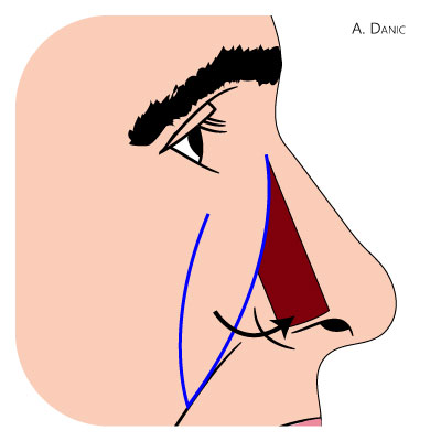 Lambeau nasogénien en 1 temps - lambeauclic