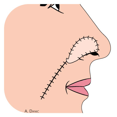 Lambeau nasogénien selon Burget - lambeauclic