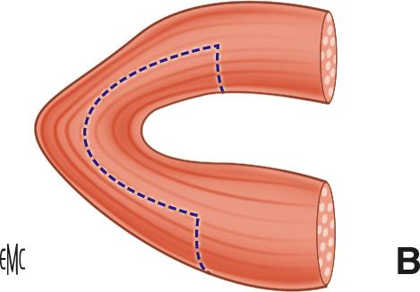 Commissuroplastie - lambeauclic