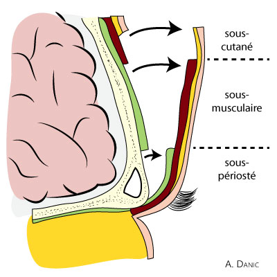 Lambeau frontal à pédicule transitoire - lambeauclic