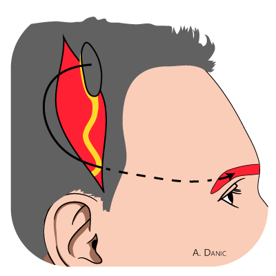 Lambeau de scalp pédiculé - lambeauclic