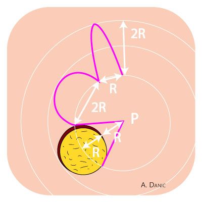 Lambeau bilobé - lambeauclic