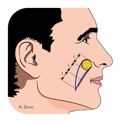 Lambeau en îlot vertical - lambeauclic