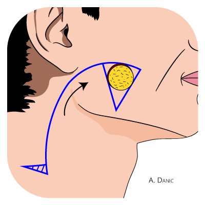 Lambeau de rotation latéro-cervical - lambeauclic