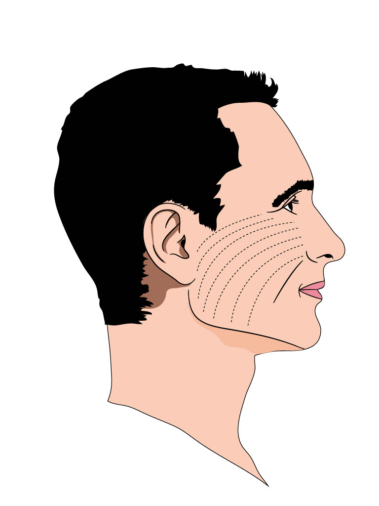 Exérèse-suture - lambeauclic